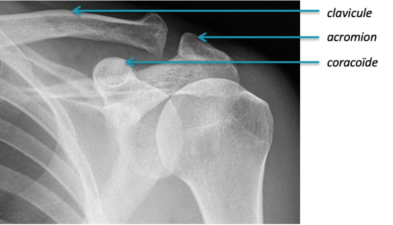 Disjonction Acromio-Claviculaire - IECEM