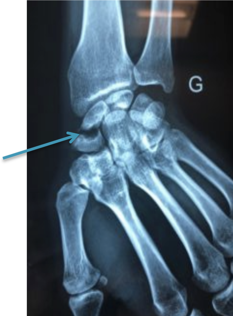 Fracture du scaphoïde - IECEM